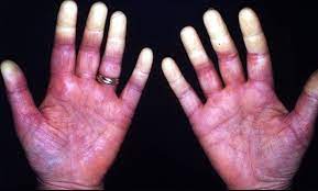 Fenômeno de Raynaud: sintomas e tratamento · Anatomia de uma leitora